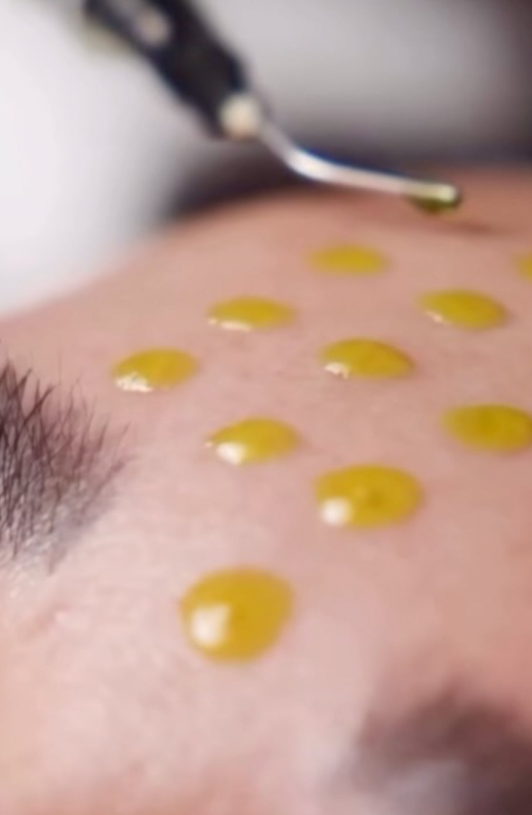 BioRePeel Combo | Peel, Skin Needling and Heal-lite Therapy - Latari ...